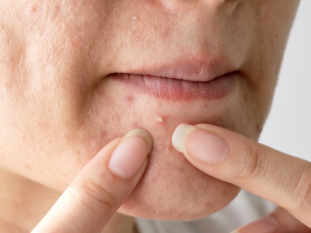 Whiteheads Remove Using Natural Way Skin Care Top News