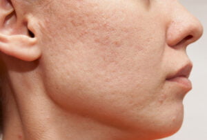 5 Different Types of Skin Blemishes on The Face And Its Treatments