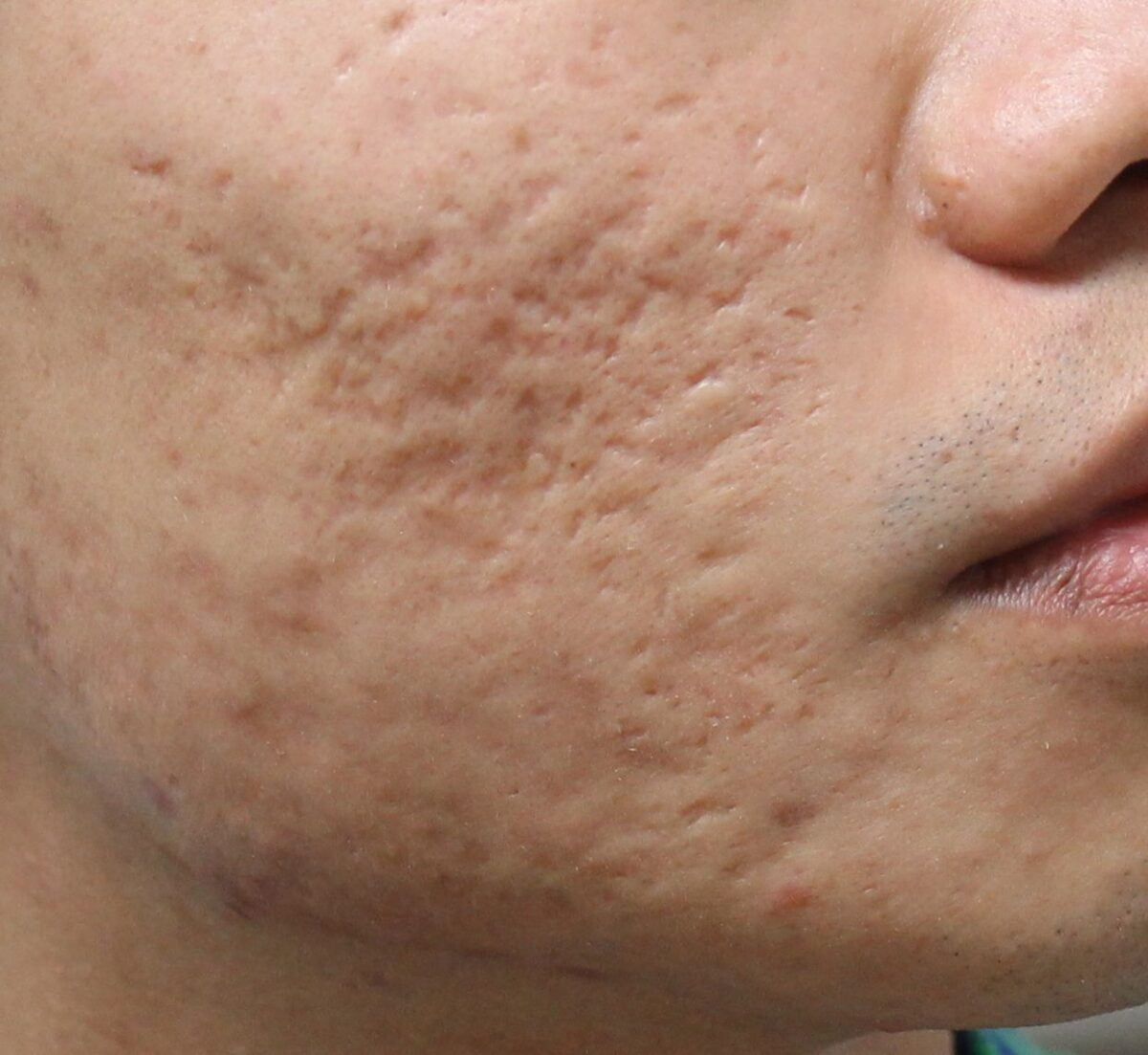 6 Ways to Get Rid of Ugly Scars Naturally! Some scars heal fast while