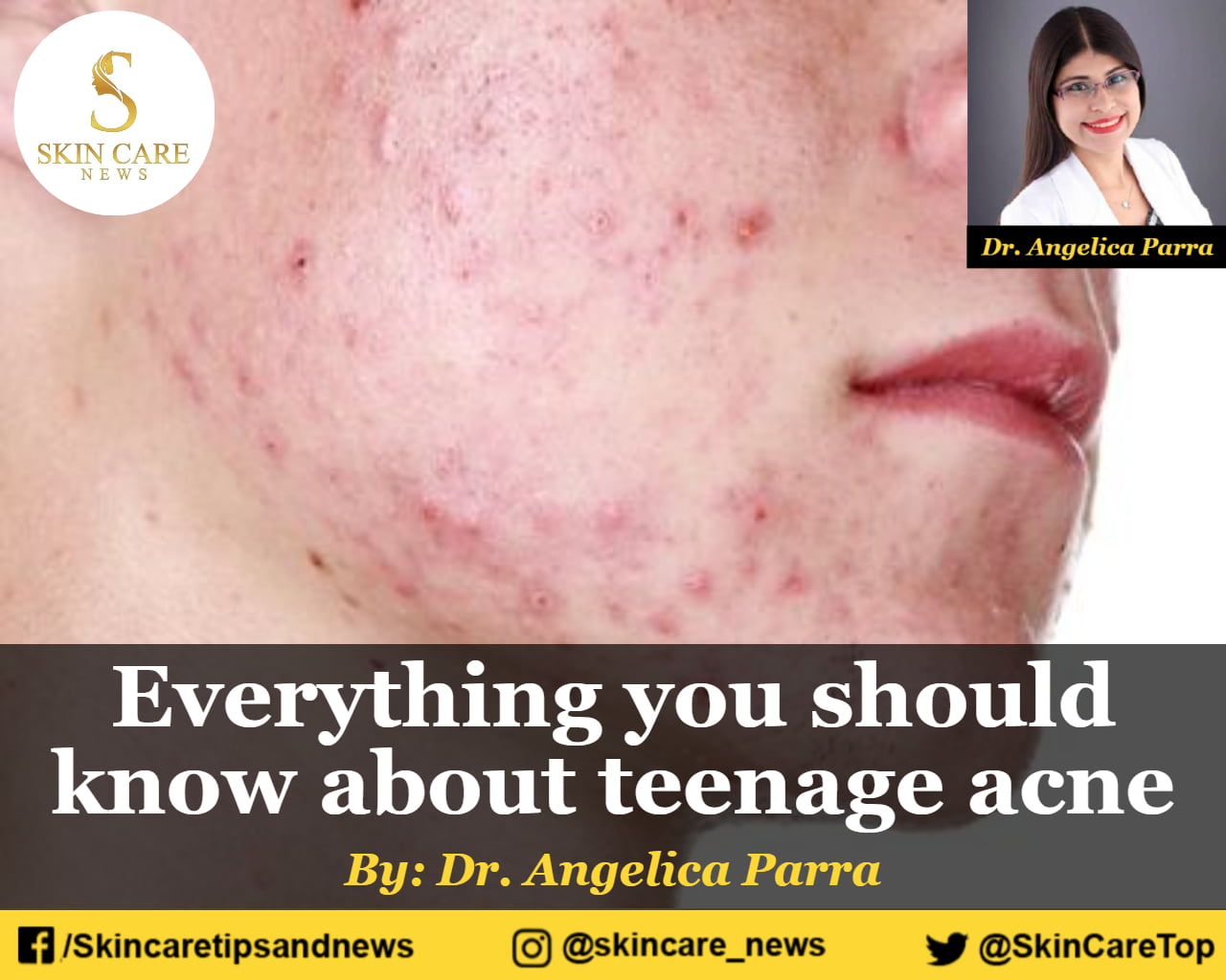 Everything You Should Know About Teenage Acne