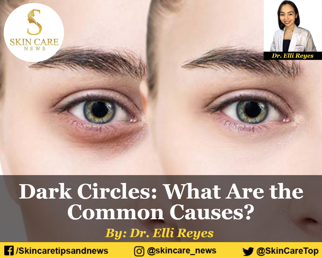 Dark Circles under Eyes: What Are the Common Causes?