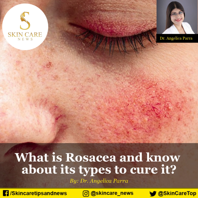 What is Rosacea and know about its types to cure it?