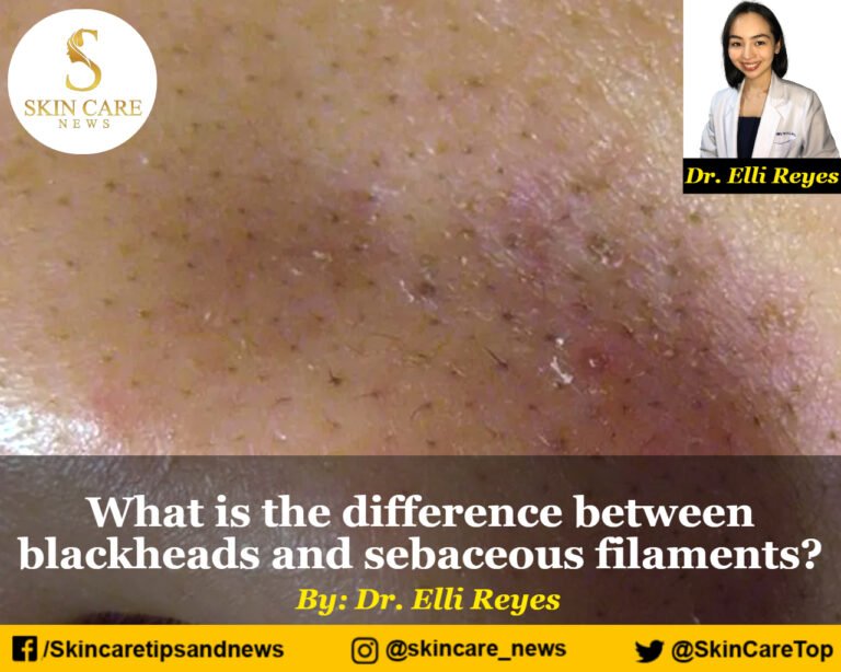 What is the difference between blackheads and sebaceous filaments?