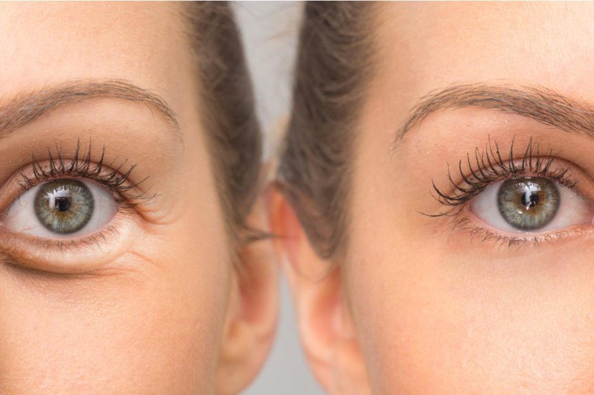 What are under eye bags and how to get rid of them?