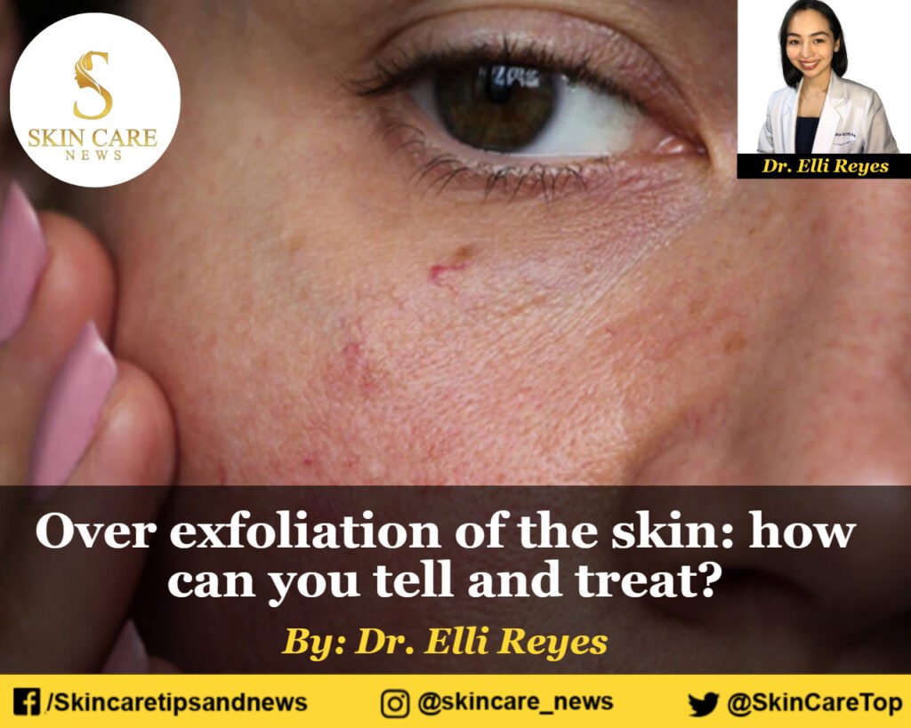 Over Exfoliation of the Skin: How Can You Tell and Treat?