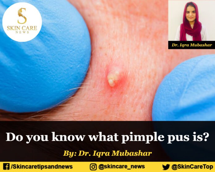 Do You Know What Pimple Pus Is? : Skin Care Top News