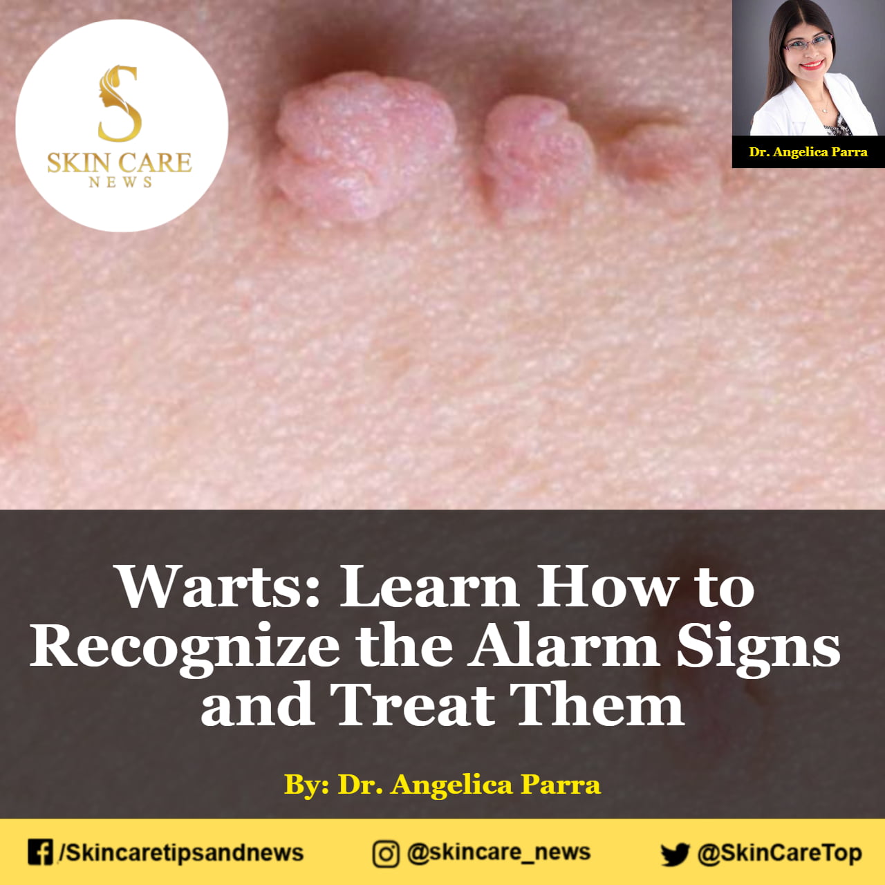 Warts: Learn How to Recognize the Alarm Signs and Treat Them