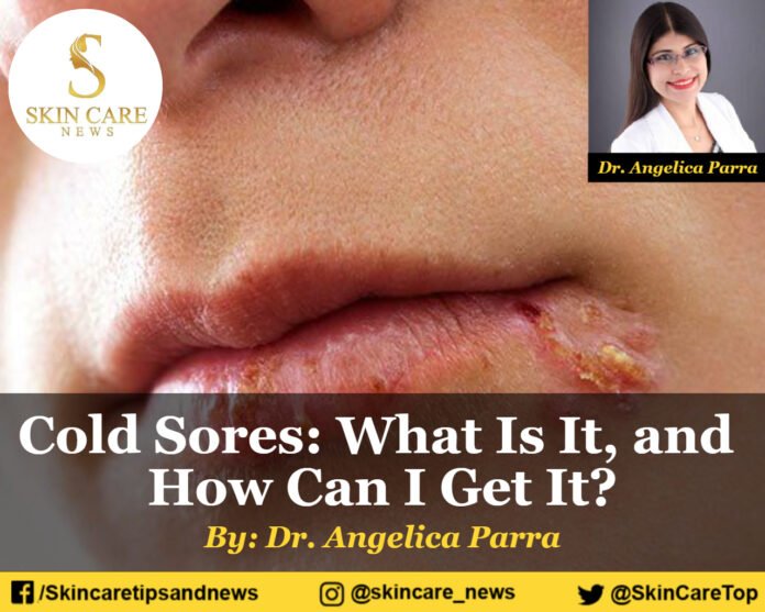 What is Cold Sores and How Can I Get Cold Sores?
