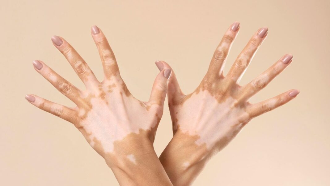 Why is my skin turning white? Do I have Vitiligo? - Skincare Top News