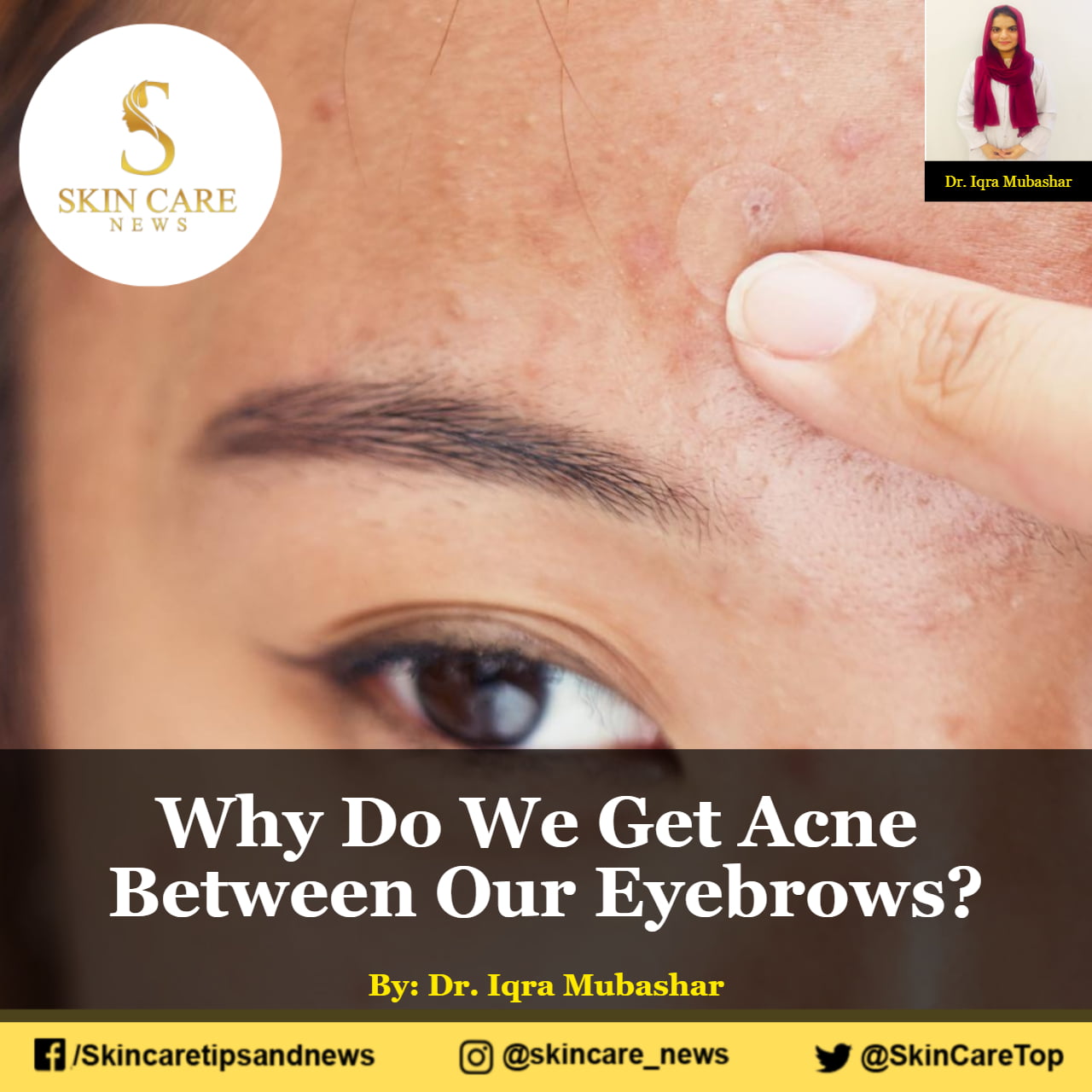 Why Do We Get Acne Between Our Eyebrows?