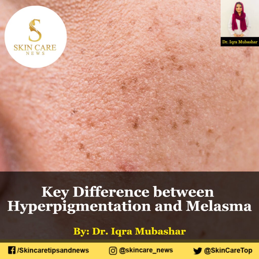 Key Difference between Hyperpigmentation and Melasma