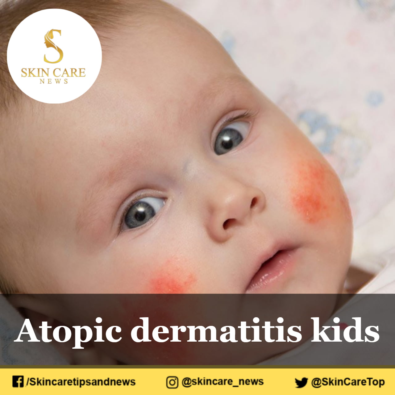 Atopic dermatitis kids