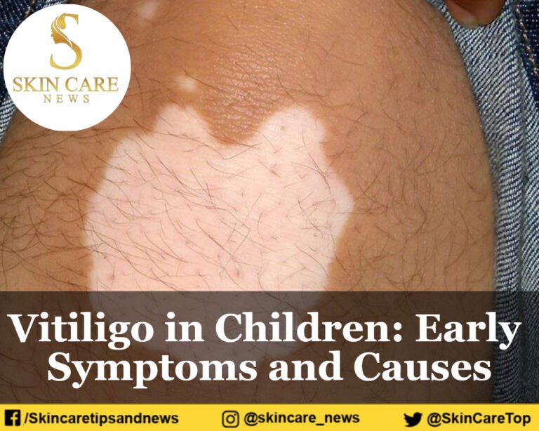 Vitiligo in Children: Early Symptoms and Causes