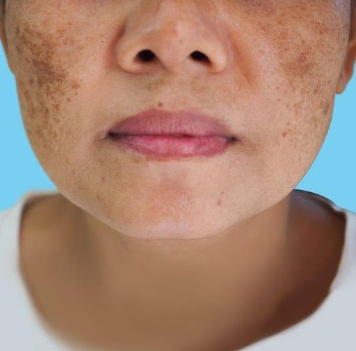 Key Difference between Hyperpigmentation and Melasma