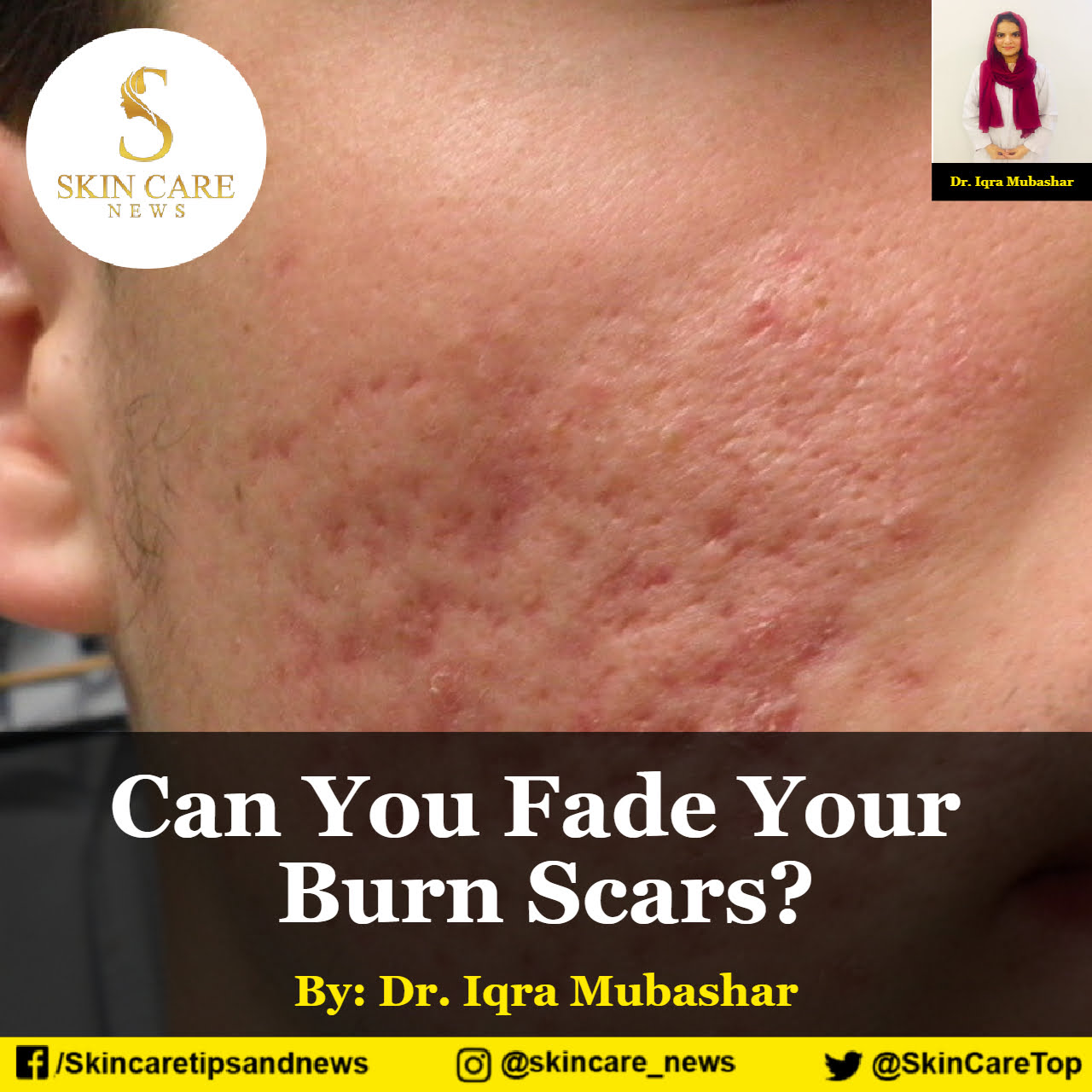 Can You Fade Your Burn Scars?