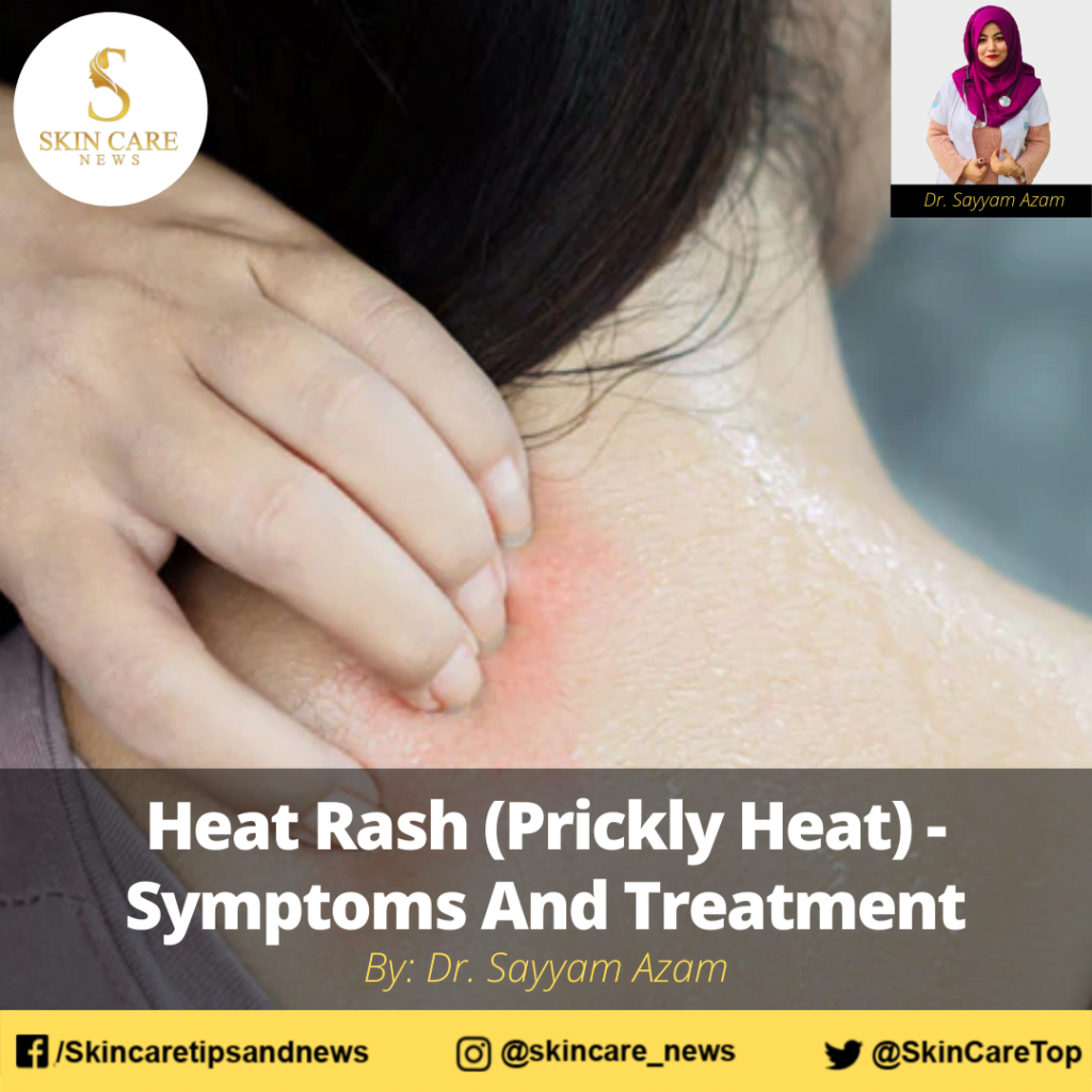 Heat Rash (Prickly Heat) - Symptoms And Treatment