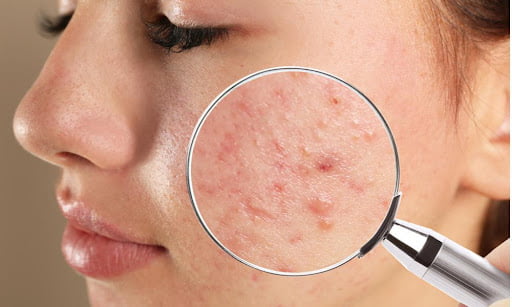 Things To Do If You Have Fungal Acne
