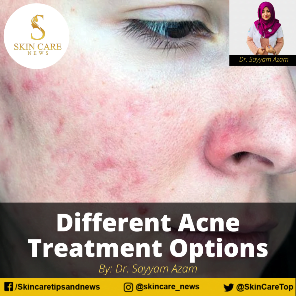 Different Acne Treatment Options
