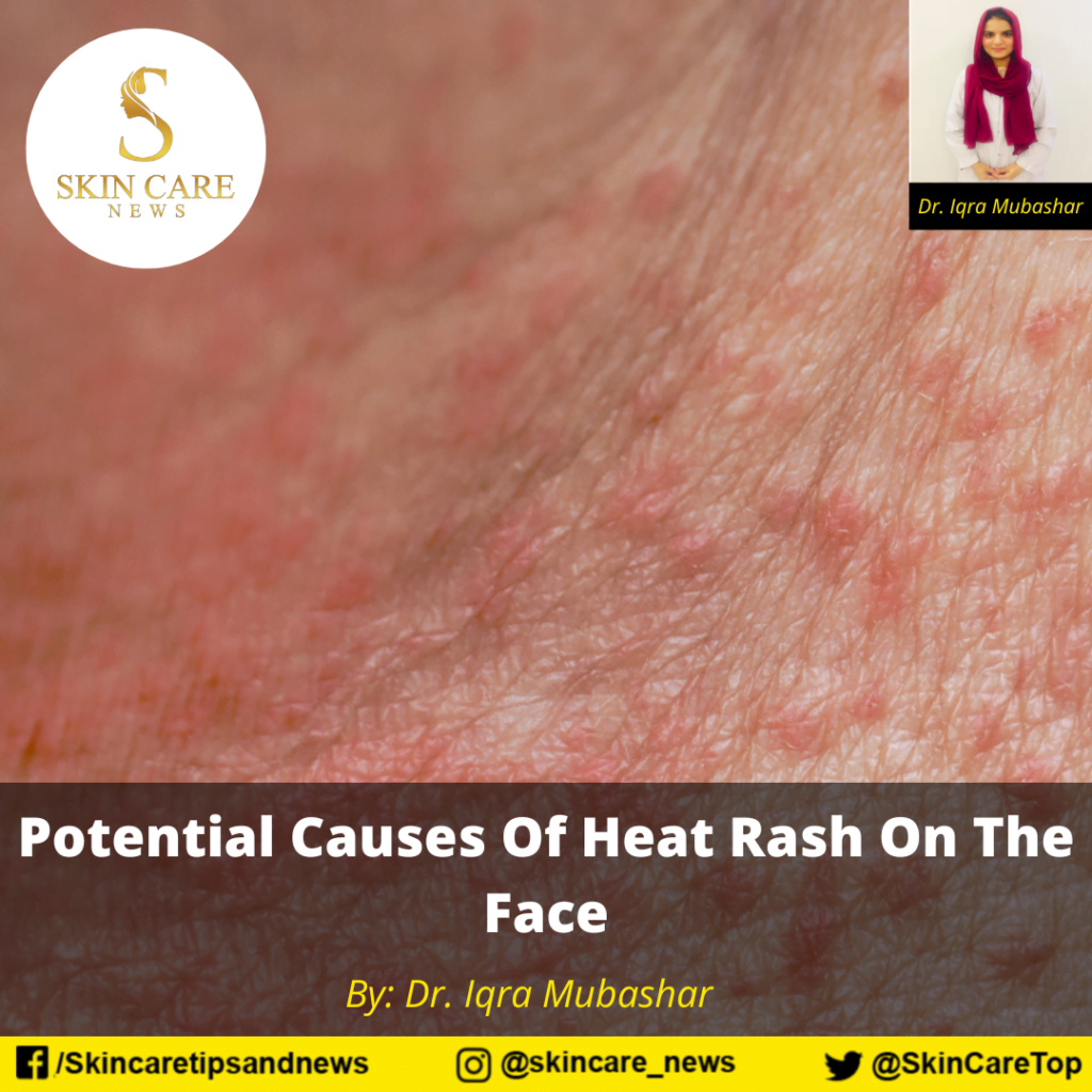 Potential Causes Of Heat Rash On The Face
