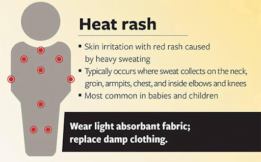 All You Need To Know About Heat Rash