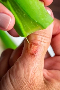 Healing Burnt Skin With Aloe Vera Gel