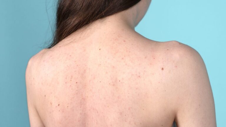 How to fight acne on the back, also known as “backne”