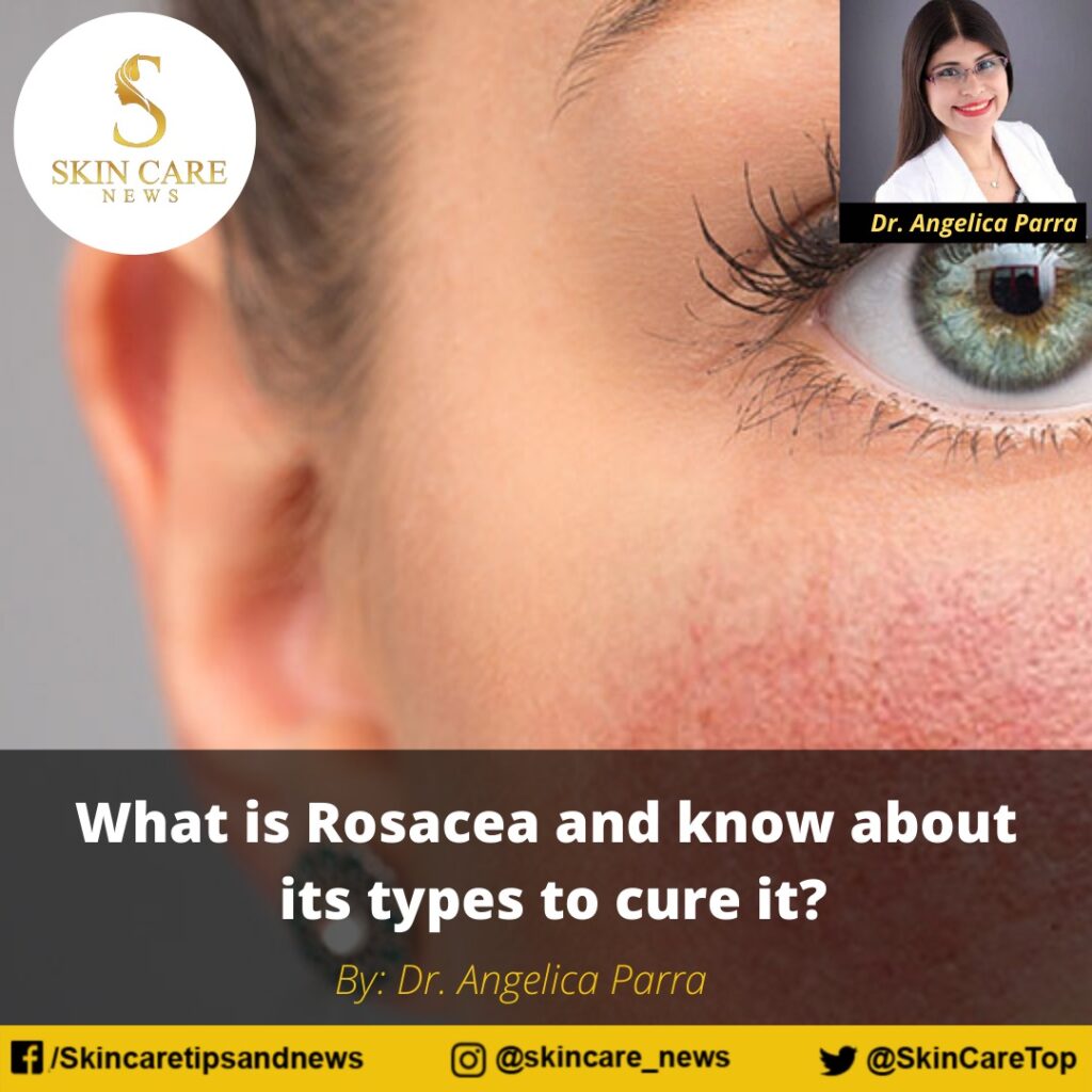 What is Rosacea and know about its types to cure it?