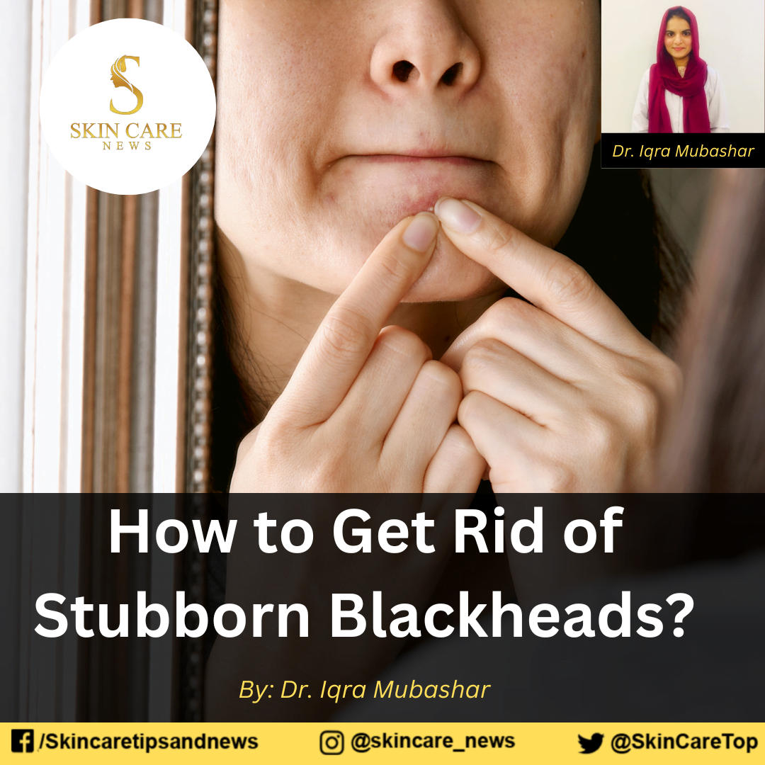 How To Get Rid Of Stubborn Blackheads