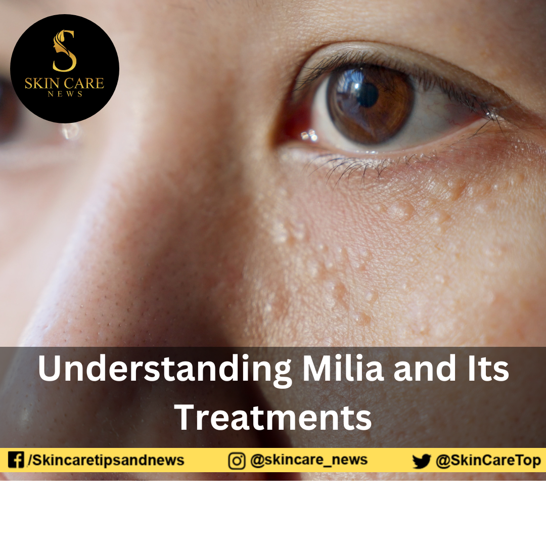 Understanding Milia and Its Treatments